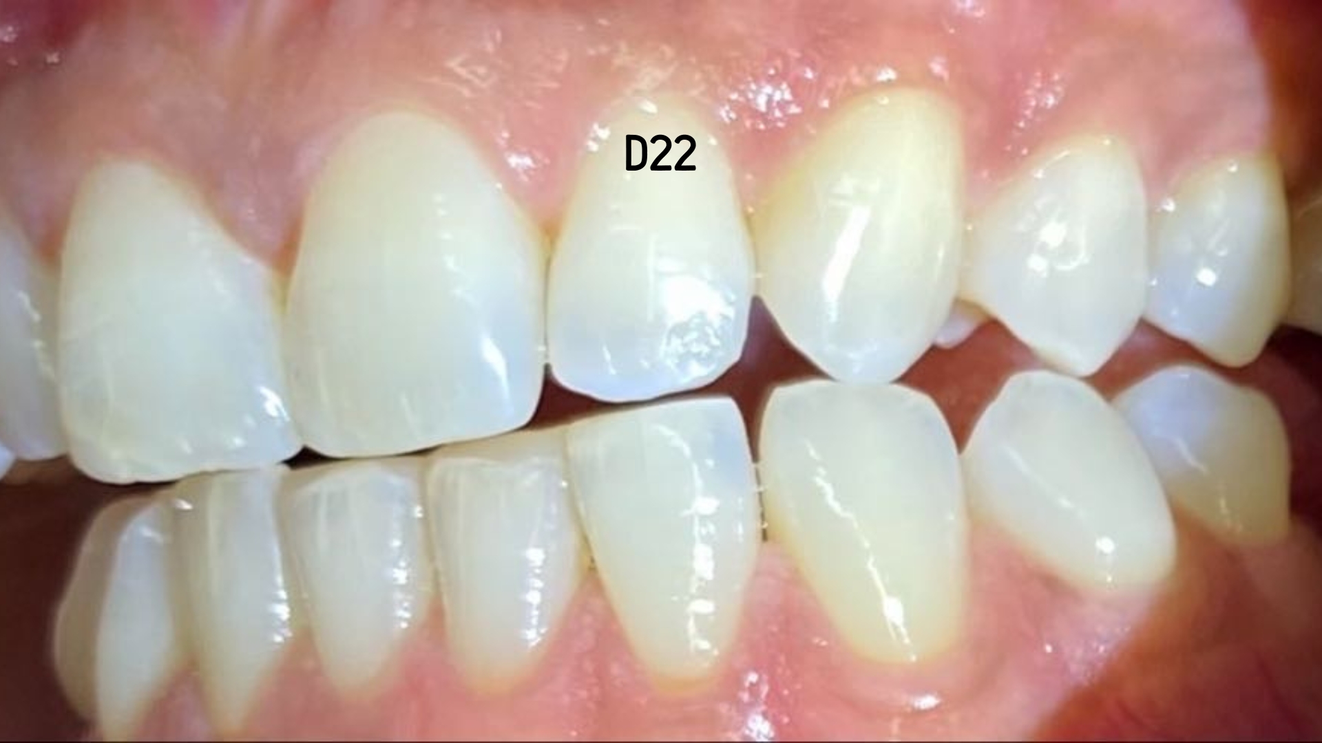 Kuluneiden hampaiden korjaus - Ykiniemi